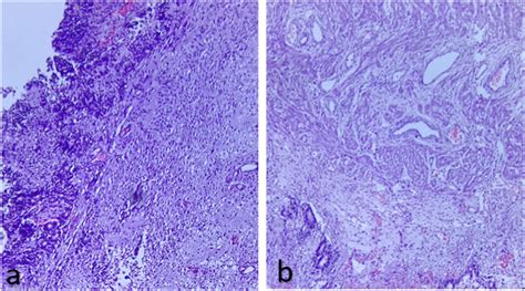A Immature Neuroectoderm B Rosettes Of Immature Neuroepithelium