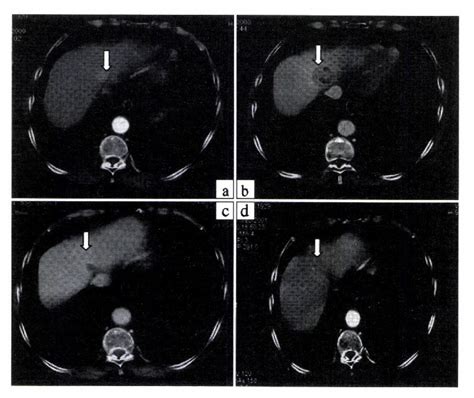 Figure 1 From A Case Of Hepatocellular Carcinoma With Spontaneous Regression Of Primary Tumor