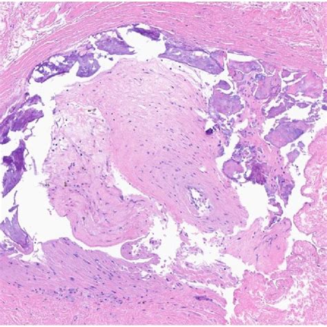 Spermatic Cord Artery Demonstrating Intimal Fibrosis And Calcification