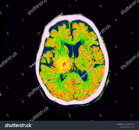 Ct Brain Perfusion Ct Scan Image Stock Illustration 2376417531 Shutterstock