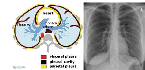 Outlines Of Lung On Cxr