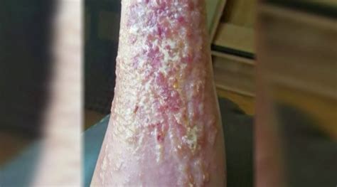 Wild Parsnip Omahas Pretty But Toxic Flower