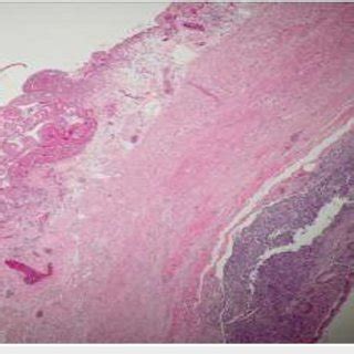 Appendix With Keratin Deposits In The Surface Of The Serosa Arrow