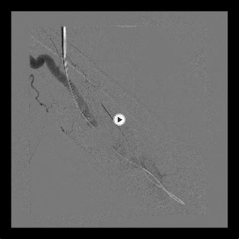 Figure 1 From Eight Cases Of Endovascular Embolisation By Balloon