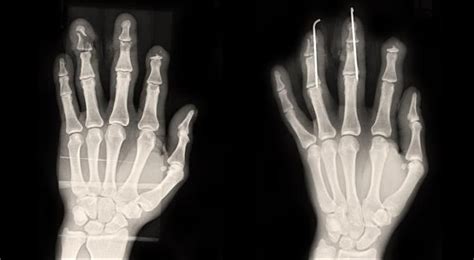 Hand Fractures Open Reduction Internal Fixation