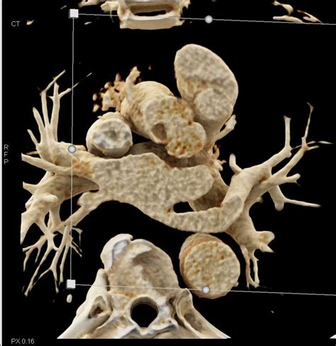 Papillary Fibroelastoma Off Aortic Valve Cardiac Case Studies