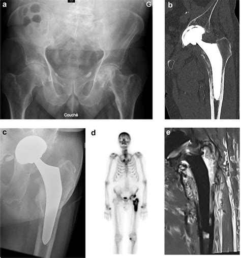 Case 1 Dedifferentiated Chondrosarcoma A Initial Plain Films Download Scientific Diagram