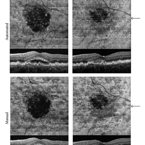 En Face Oct Images Generated By Automated And Manual Segmentation At