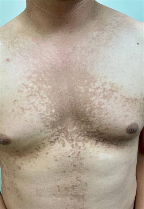 Dermatologic Look Alikes Scaly Hyperpigmented Papules On Trunk