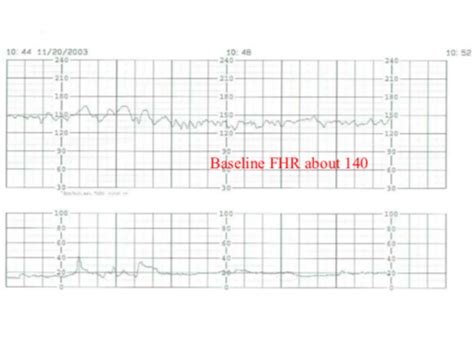 Obstetrics Cardiotocograph Ctg Interpretation Flashcards Quizlet Obstetrics Cardiotocograph Ctg Interpretation Flashcards Quizlet