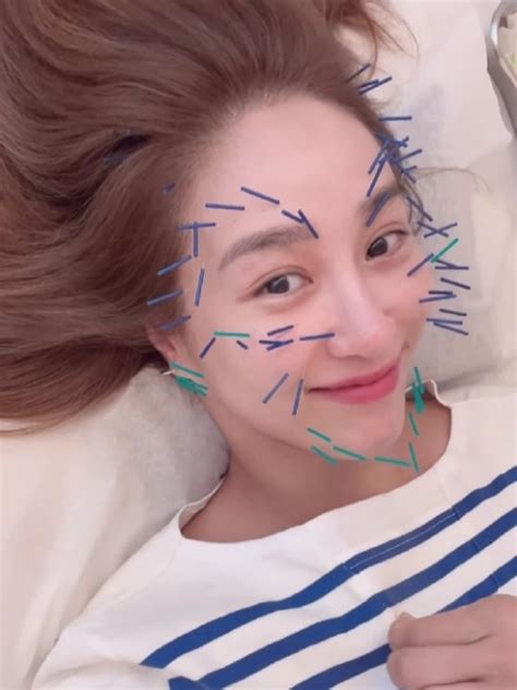 옥주현 얼굴에 침 수십 개 꽂고 유유자적