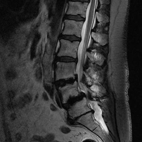 Preoperative Lumbar Mri Demonstrating L5 S1 Disc Bulge With Disc