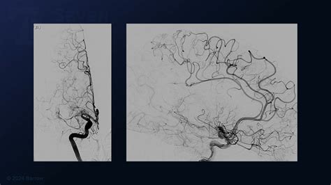 469 Occipital Artery To Anterior Inferior Cerebellar Artery Bypass