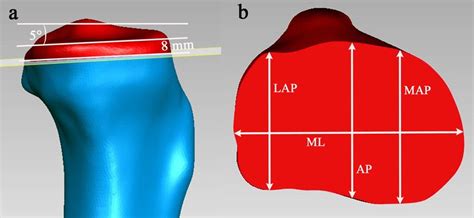 Proximal Tibia Resection And Measurement On Ct Images A Resection