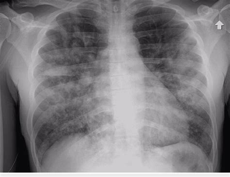 Chest Radiography Showing Diffuse Multifocal Nodular Opacities