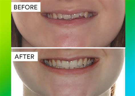 Unilateral Posterior Crossbite And Anterior Open Bite Solventum