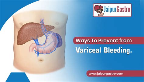Ways To Prevent From Variceal Bleeding