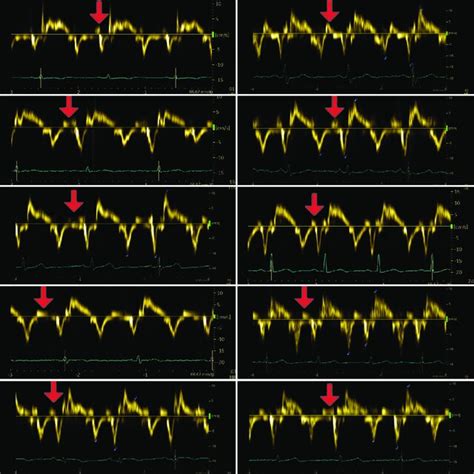 In Sample 10 Patients With Normal Lv Diastolic Function The Download Scientific Diagram
