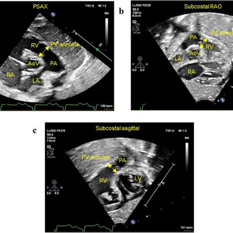 Key Echocardiographic Views Demonstrating Measurement Of Pulmonary Download Scientific Diagram