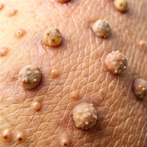 Severe Skin Condition Illustration With Blister And Warts Focus