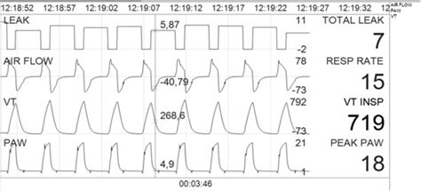 Display Of The Flow Time Pressuretime Volume Time Graphs And