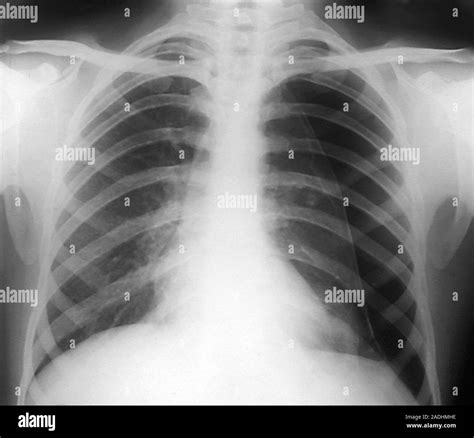 Pneumothorax Frontal Chest X Ray Of A Patient With A Pneumothorax Or Collapsed Lung Air Has