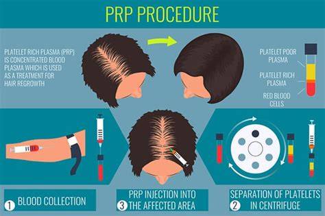 PRP Study Extended Articles News Sara Wasserbauer MD