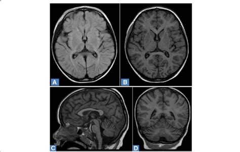 Brain Mri Of 5 Year Old Girl With Ncl7 A Diffuse Cortical Atrophy Download Scientific