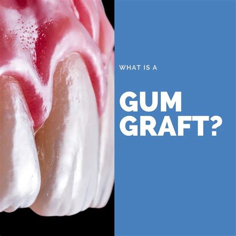 What Is A Gum Graft Chicago Dental Implants