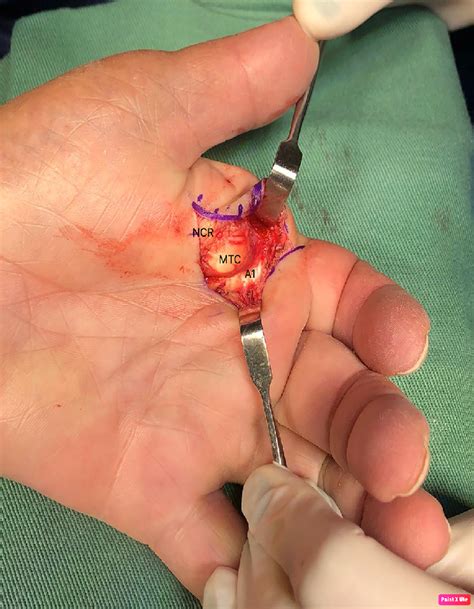 Intraoperative Images Classic Appearance In Volar Exposure The