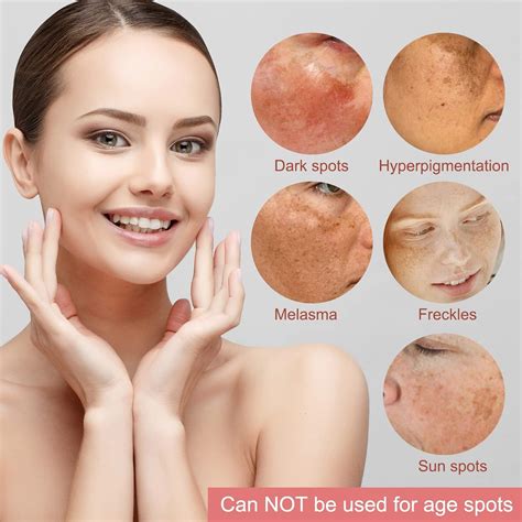 Dark Spot Remover For Face And Body Melasma Sun Spots Freckle