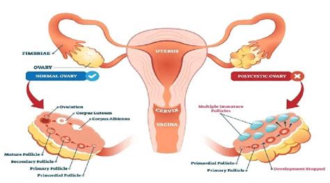 Figure From Transfer Based Deep Learning Technique For Pcos Detection Using Ultrasound Images