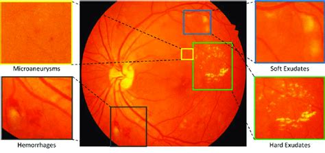 Color Fundus Photograph Containing Different Retinal Lesions Associated Download Scientific