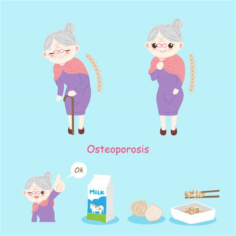Royalty Free Osteoporosis Fracture Clip Art Vector Images