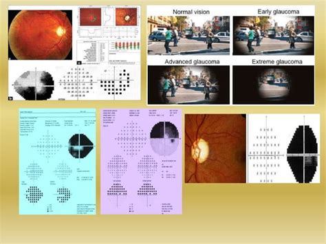 Visual Field Analysis Interpretation Pptx Eye And Vision Conditions Diseases And Conditions