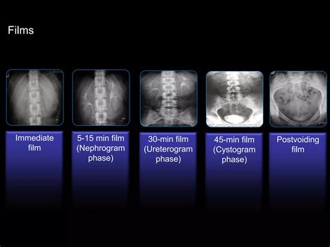 Intravenous Urography Ivu Pdf Digestive Disorders Diseases And Conditions