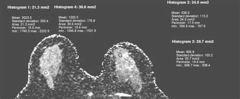 ADC Map Shows Values Range From Of The Left Breast The Right Download Scientific