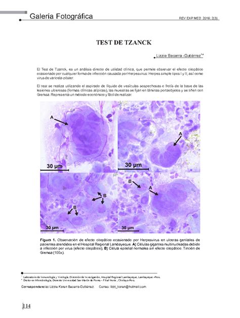 Células De Tzanck