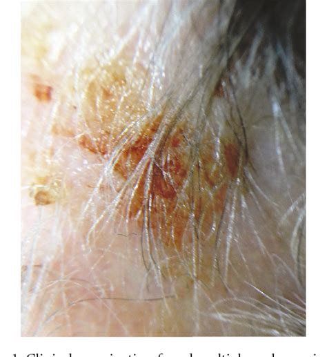Figure 1 From Erosive Pustular Dermatosis Of The Scalp With Urate Like