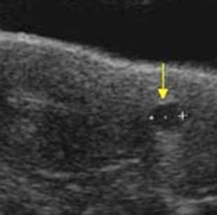 Nabothian Cyst In Cervix Pictures Symptoms Causes Ultrasound