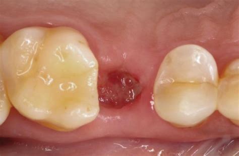 Healing Stages Of A Normal Socket After Tooth Extraction A Complete Guide To Recovery And Care