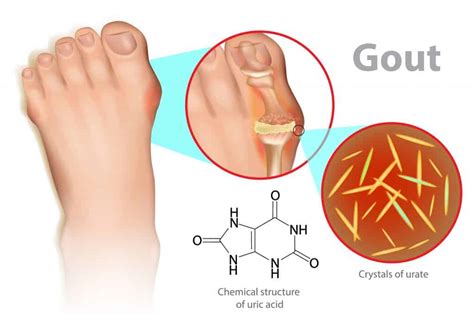 Gout In Feet And Ankles At William Christy Blog