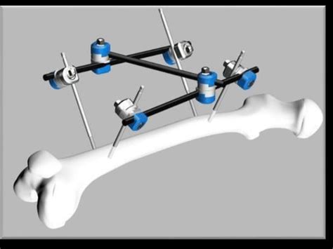 Modular External Fixator System By MadisonOrtho By Andrewrodrigues Issuu