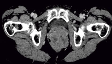 Rectal GIST Resection Following Neoadjuvant Therapy Reporting Two Cases From A Single Institute