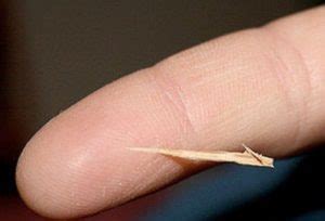How To Remove A Splinter