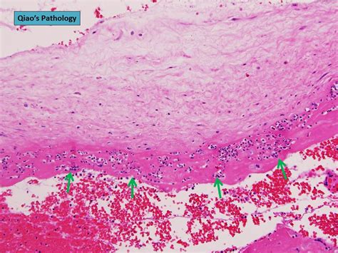 Qiaos Pathology Acute Subchorionitis A Photo On Flickriver