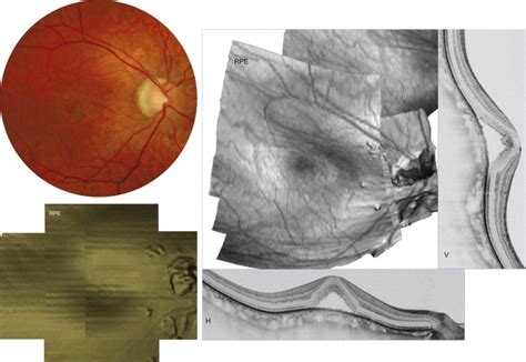 Morphologic Characterization Of Dome Shaped Macula In Myopic Eyes With Serous Macular Detachment