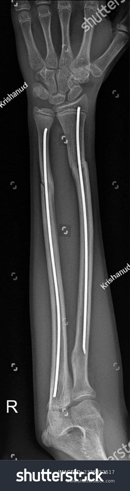 Ulna Fracture X Ray