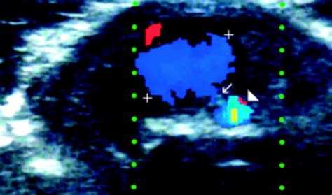 Radial Artery Pseudoaneurysm Successfully Treated By Compression