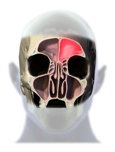 Nuevo Procedimiento Para Tratar La Sinusitis De Los Senos Paranasales